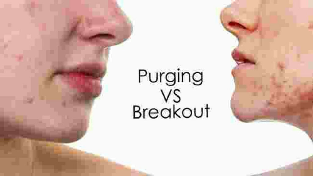 Perbedaan Purging Dan Breakout Setelah Penggunaan Skincare